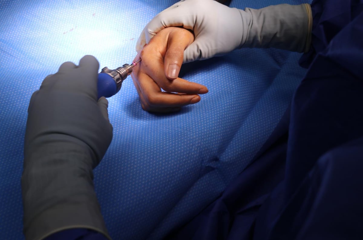 Use of NX Nail for oblique fracture fixation of 2nd metacarpal